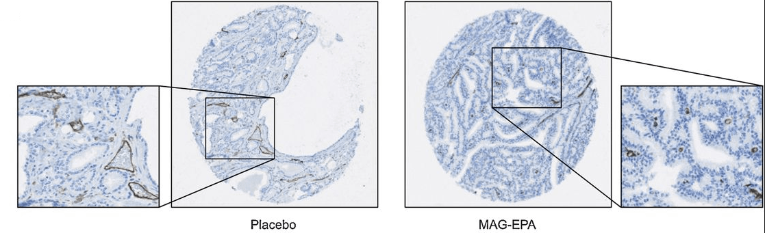 MAG-EPA's Role in Prostate Cancer: Insights from Phase IIb RCT-EPA Tri